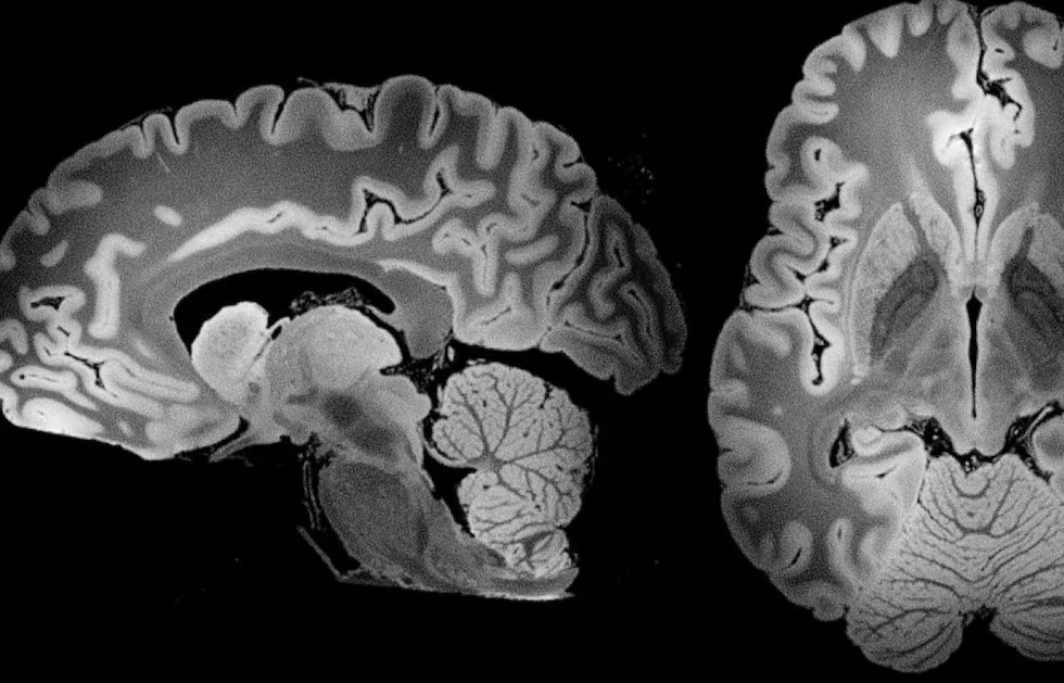 Un estudio advierte sobre la presencia de microplásticos en el cerebro ...